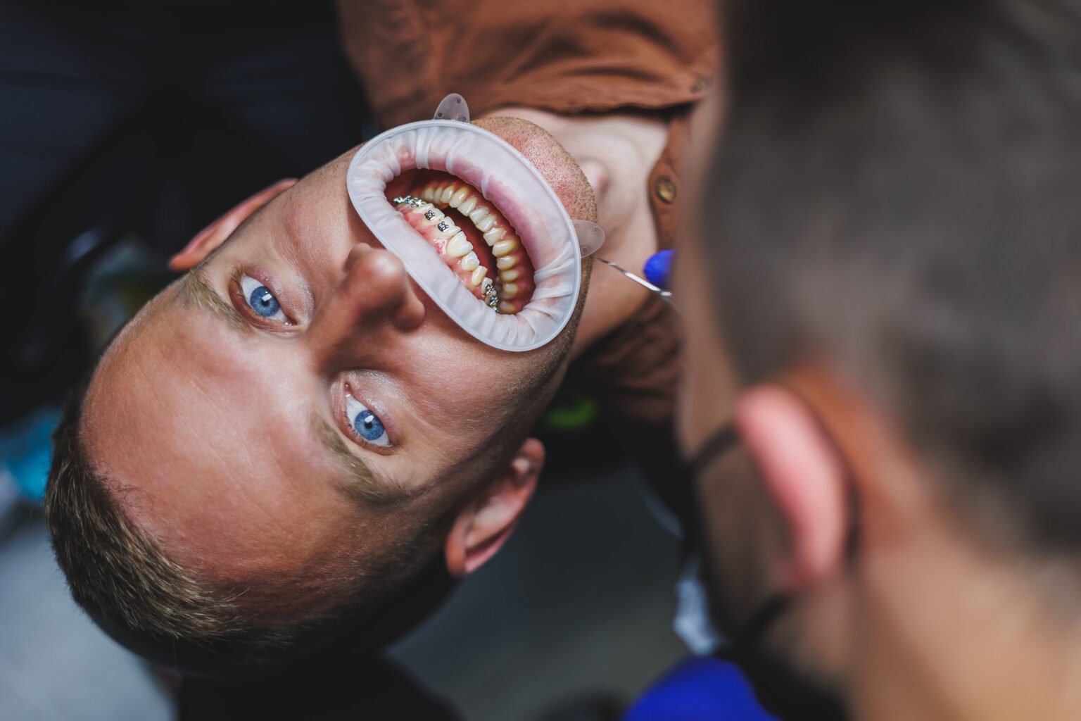 Lip Flip Fail: 7 Critical Signs & Expert Fixes